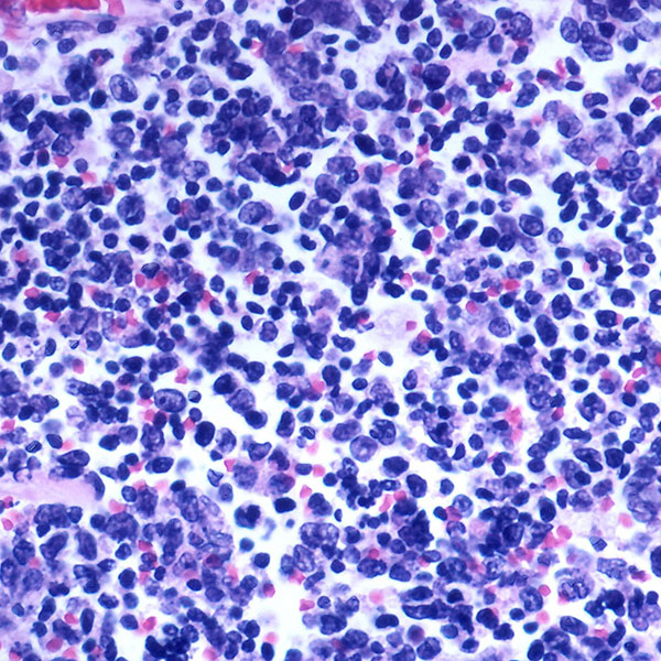 What’s New in Small Cell Lung Cancer Research? - The Joan DeCotis ...